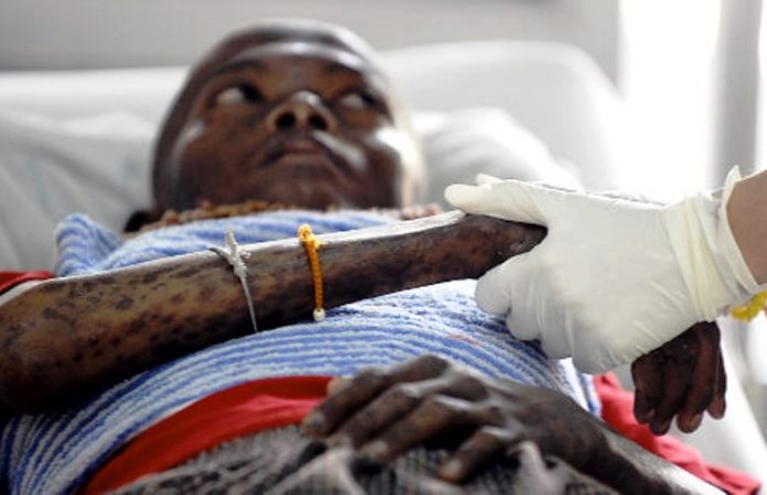 London patient cured of HIV-AIDS in medical breakthrough - OtownGist Media